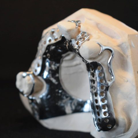 Avtagbar protetik | Artem dental lab